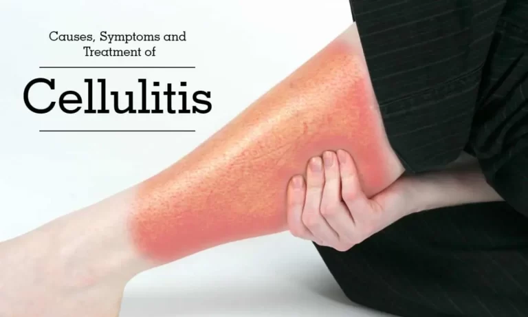 cellulitis sepsis symptoms Archives - Samarpan Physiotherapy Clinic